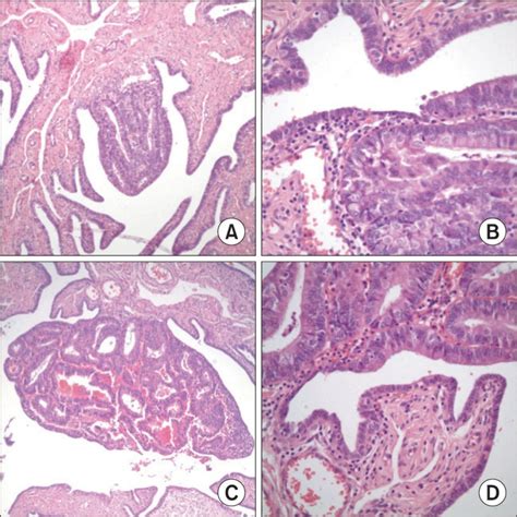 These Proliferative Glandular Lesions Were Observed In Different Areas