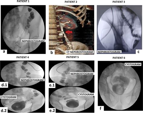 Postoperative Follow Up Imaging Studies A Normal Nephrostogram After