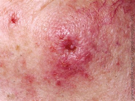 Diagnosis And Treatment Of Basal Cell And Squamous Cell Carcinoma Aafp