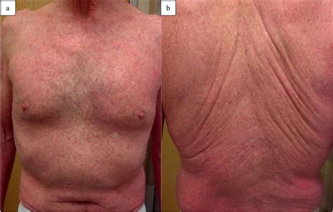 Chest And Abdomen A And Back B Revealing Diffuse Erythroderma That