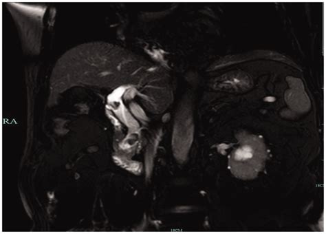 Multiple Nodular Filling Defects Are Observed In The Common Bile Duct