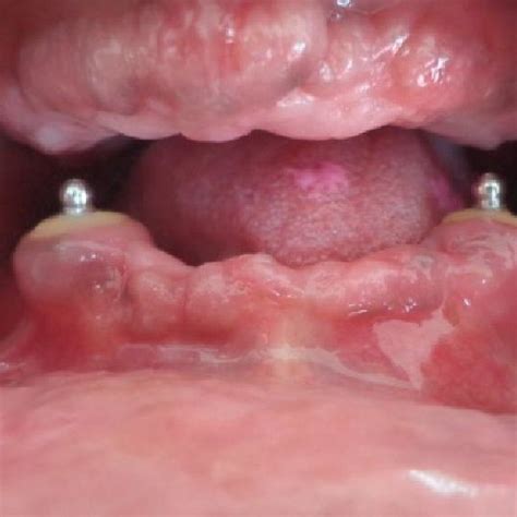 Pdf An Access Post Overdenture A Case Report