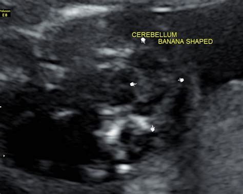 Banana Sign Ultrasound Banana Sign Looking Through A Transducer