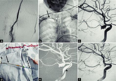 A A 37 Year Old Female Presented With Sah Due To Ruptured Right Pcom Download Scientific A A 37 Year Old Female Presented With Sah Due To Ruptured Right Pcom Download Scientific