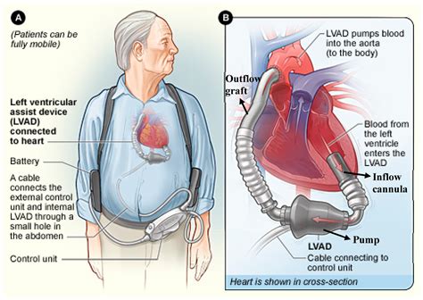 Lvad