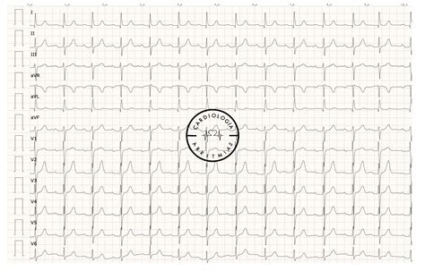 Intervalo Pr Ecg 2025