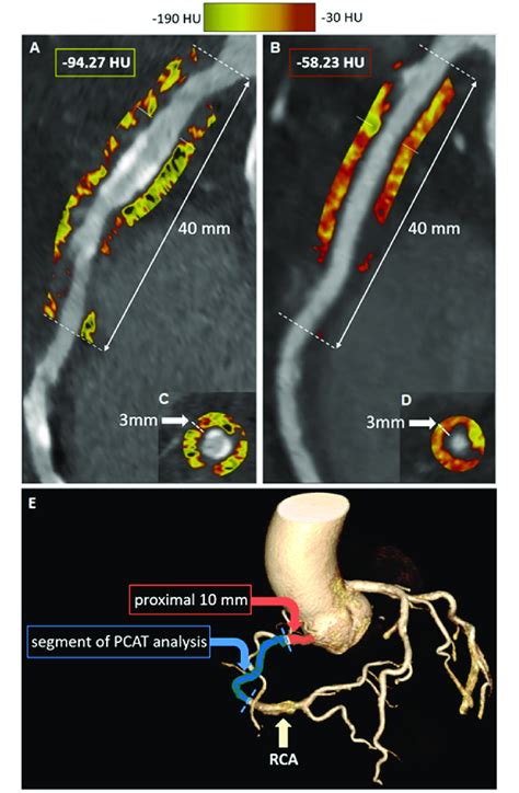 Examples Of Semi Automated Analysis Of Cta Derived Pcat Attenuation Download Scientific