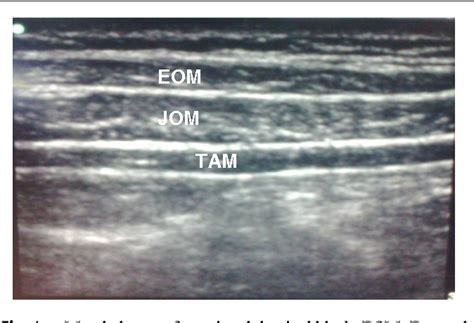 Figure 1 From Comparison Of Caudal Epidural Block And Ultrasonography Guided Transversus