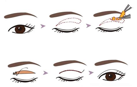 单双眼皮的遗传奥秘与手术标准