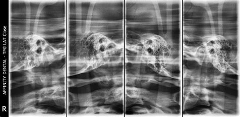 Transcranial X Ray Philippines Tmj Imaging