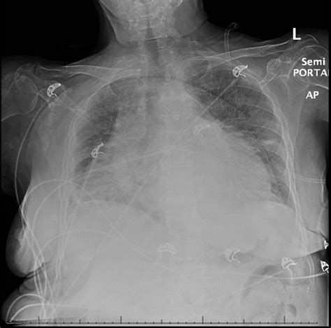 Chest Radiograph Demonstrating Enlarged Cardiac Silhouette Download