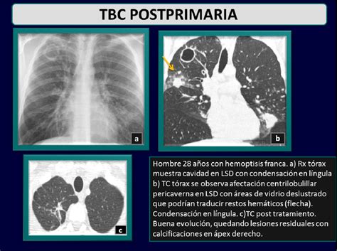 Manifestaciones Radiológicas De La Tuberculosis Pulmonar Semantic Scholar