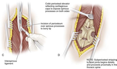 Lumbar Spine Exposure Technique At Nancy Jensen Blog