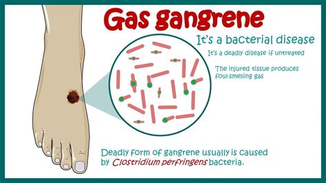 Gangrene On The Foot Causes Symptoms Risks And How To Treat