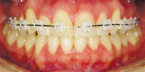 Clear Bracket Braces