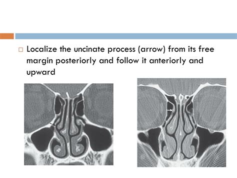 Ppt Endoscopic Sinus Surgery Powerpoint Presentation Free Download Id 186769