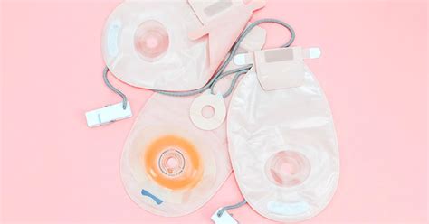 Colostomy Bag Types Uses And Procedure
