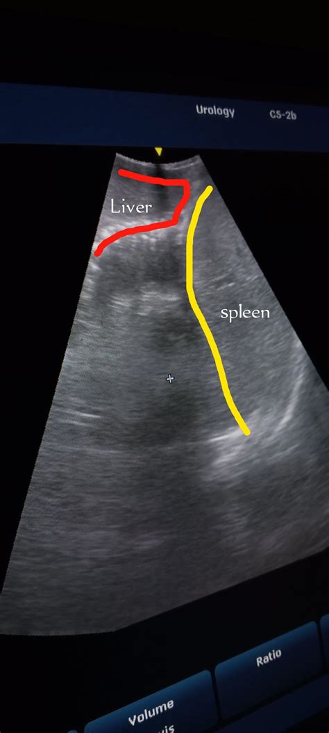 Ultrasound Signs Radiology Kissing Sign Kenan Jrera
