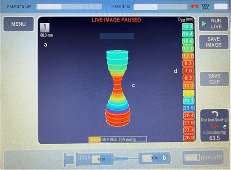 Photo Of The Endoflip Console That Shows Data About The Balloon Across Download Scientific