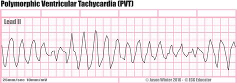 Ecg Educator Blog Polymorphic Ventricular Tachycardia Pvt