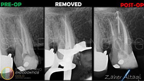 Management Of Broken Files A Clinical Approach Part 2 Style