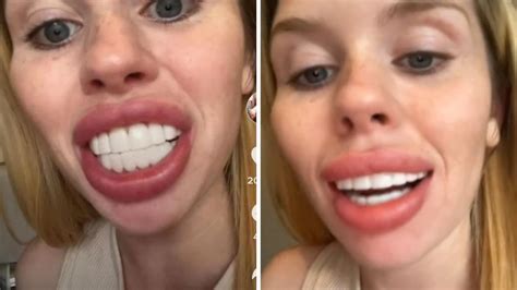 Dientes De Caballo Mujer Aprovechó Oferta De Diseño De Sonrisa Y