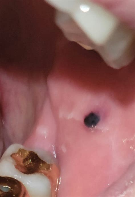 입 안에 검은 점 같은 게 생겼어요 지식in