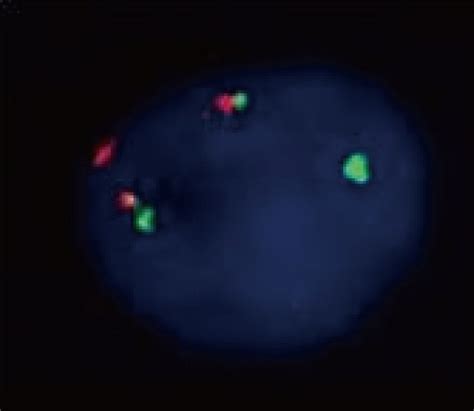 Interphase FISH Using Vysis RUNX RUNX T Dual Color Dual Fusion Download Scientific Diagram