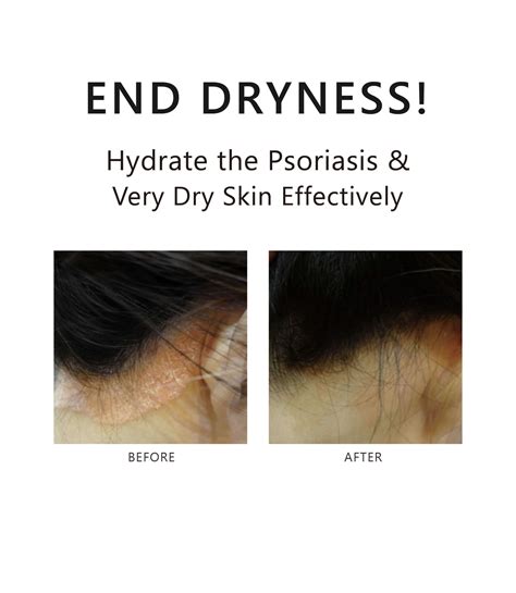 Psoriasis Scalp 3 Step Light Solution Scalp Deep Cleanser Daily Shampoo Scalp Tonic AROMASE