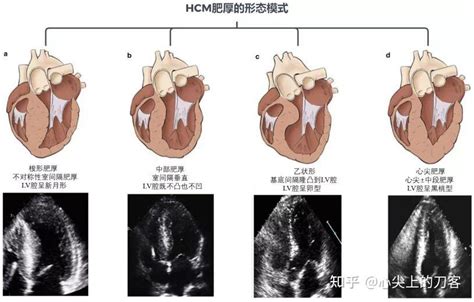 肥厚性心肌病目前有哪些诊疗方案 知乎
