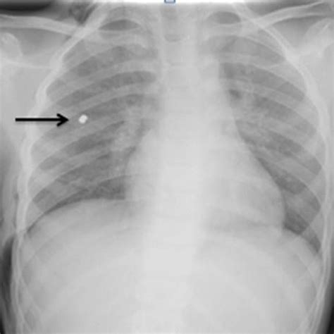 Arrow Indicating Pellet In The Right Hemithorax Download Scientific
