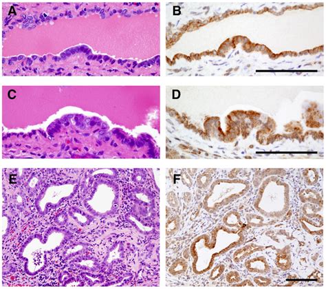 Expression Of Ercmesothelin In Pancreatic Lesions Immunostaining Of