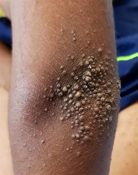 Phrynoderma Treatment