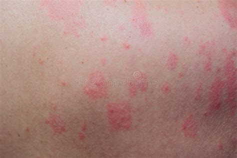 Close Up Allergy Rash Around Back View Of Human With Dermatitis Problem Of Rash Allergy Rash