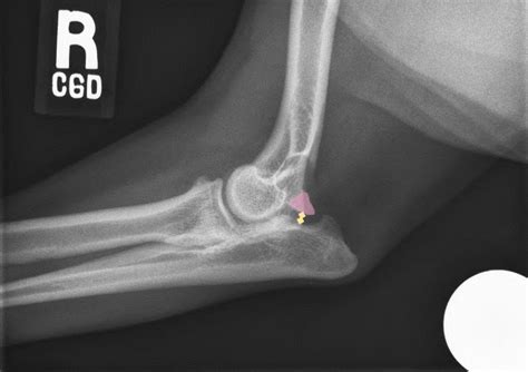 Coronoid Process Radiograph Direct Anterior Approach For Mini Plate