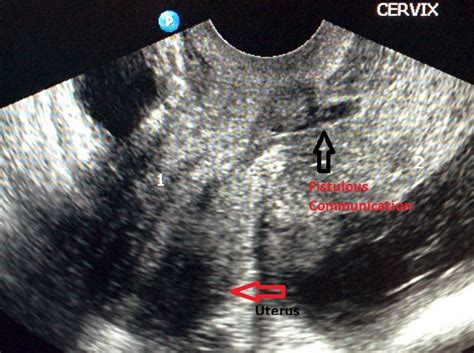Cervicitis Ultrasound