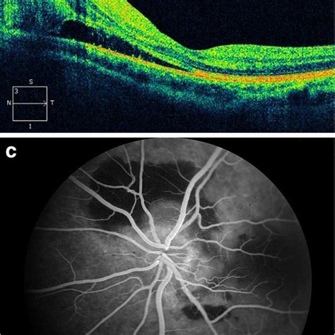 Pdf Peripapillary Choroidal Neovascularization In Pars Planitis