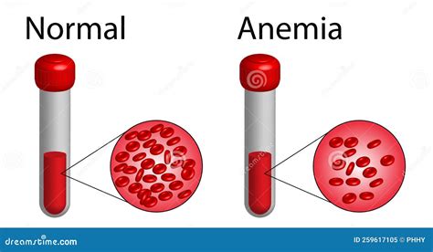 Iron Deficiency Anemia Vector Illustration Isolated On White