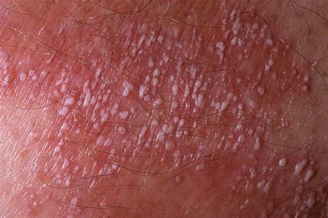 4 Pustular Psoriasis