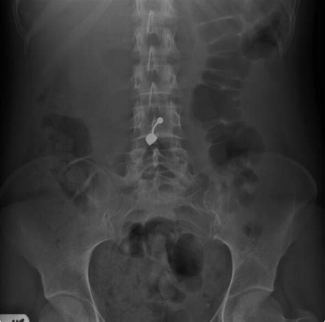 Abdominal X Ray Interpretation Axr Radiology Osce Geeky Medics