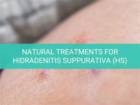Hidradenitis Suppurativa Hs Relief Houston Acupuncture