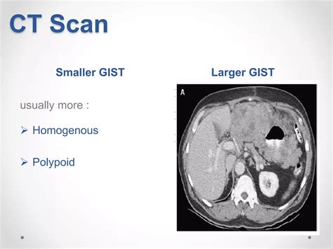 Gastrointestinal Stromal Tumour Gist D1 Pptx