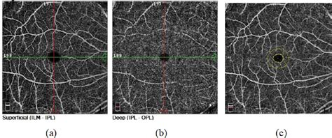 Figure 1 From Application Of Angio Optical Coherence Tomography And Flash Electroretinogram In