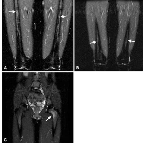 Symptomatic And Asymptomatic Findings In The Three Mri Scans Download