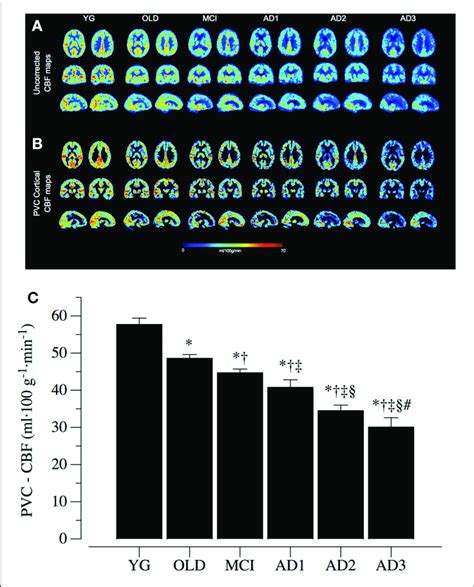 Cortical Perfusion Data A Group Whole Brain Uncorrected Cerebral Download Scientific
