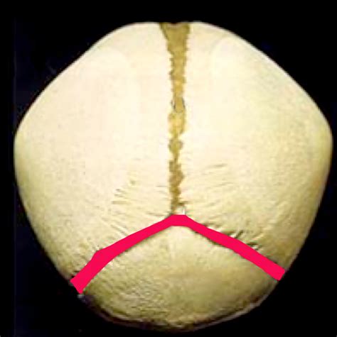 Lambdoid Synostosis Facts And Photos David F Jimenez Md