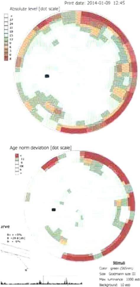 Peripheral Visual Field Affection Download Scientific Diagram