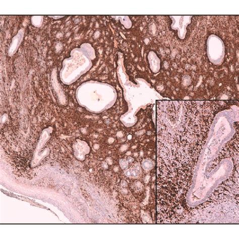 Vaginal Polyp Before And Immediately After Excision With Download Scientific Diagram