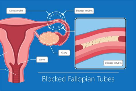 Why Ladies Suffer From Blocked Fallopian Tubes