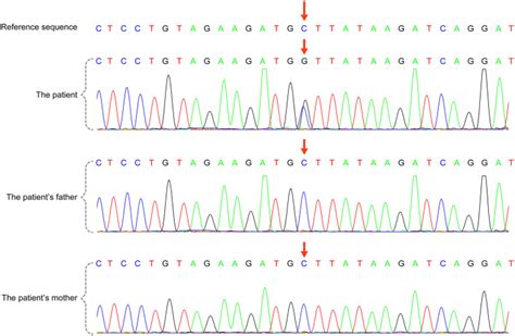 Noonan Syndrome Caused By Rit1 Gene Mutation A Case Report And Literature Review Pmc